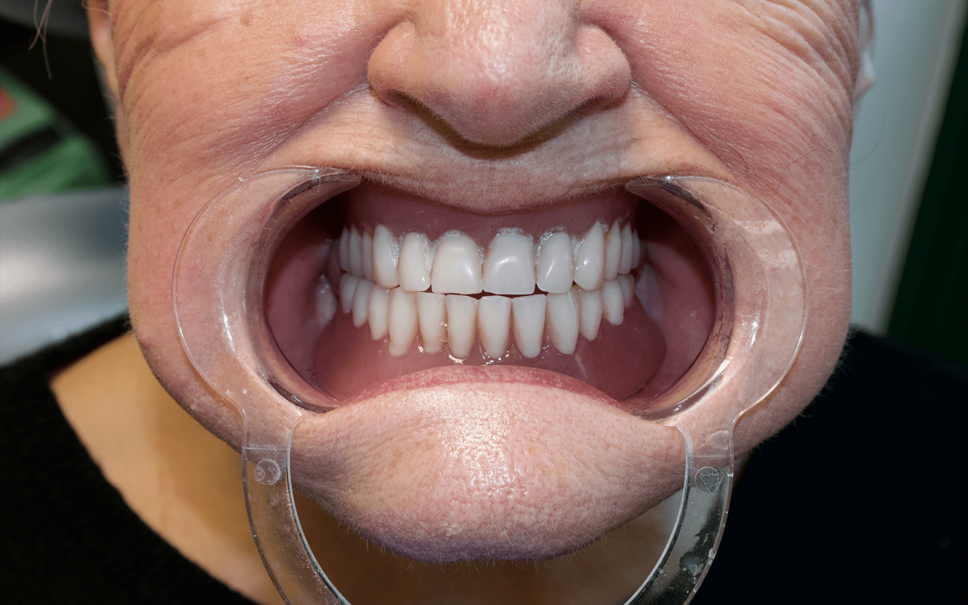 Dentures in Canford Cliffs, Bournemouth and Poole | Dental on the Banks