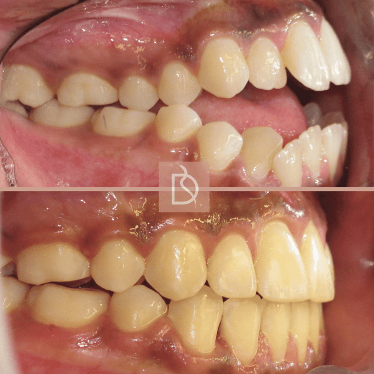 Correcting Bite Function and Jaw Misalignment with Invisalign | DOTB