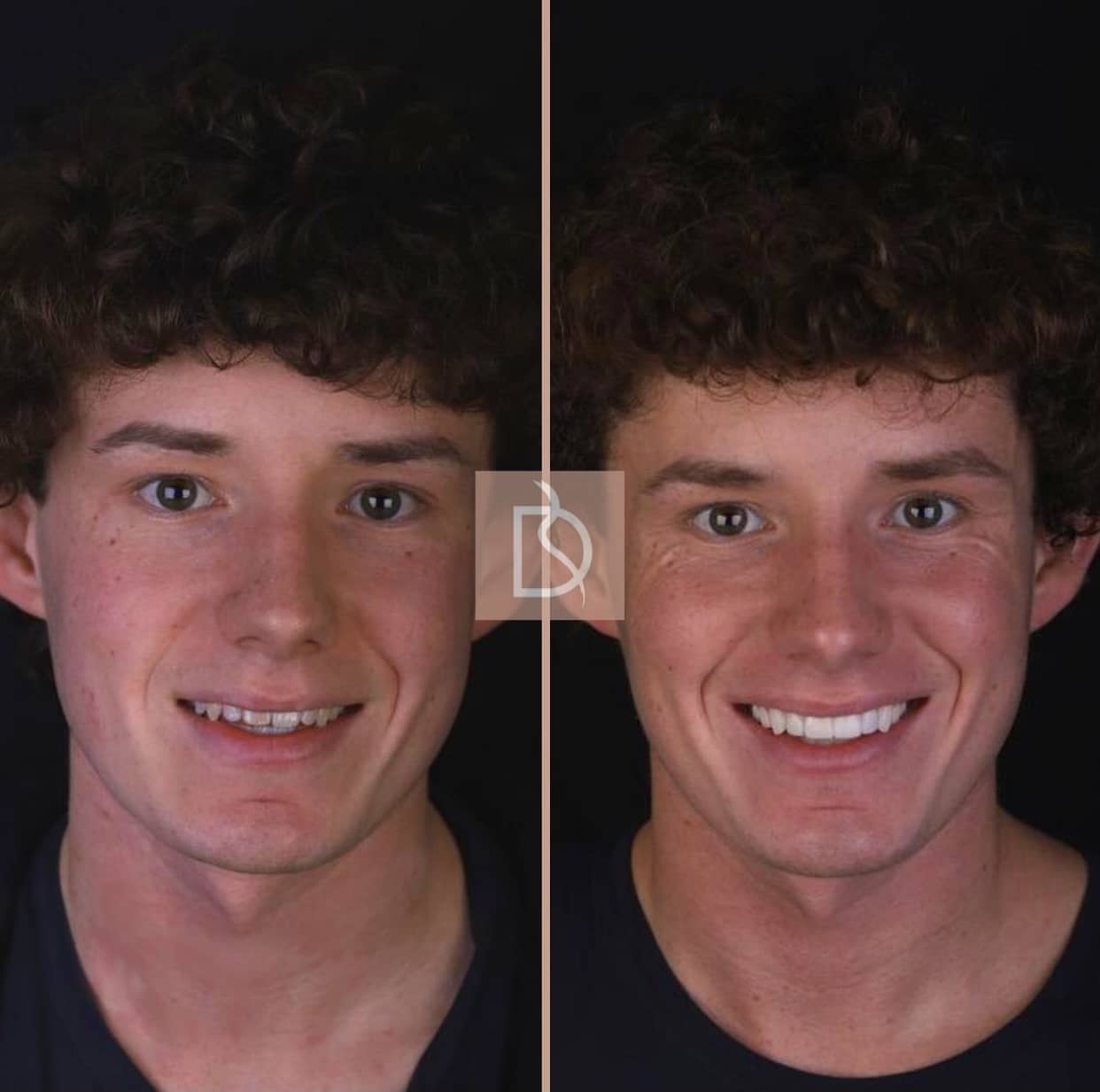 Injection Moulded Composite Bonding | Dental on the Banks