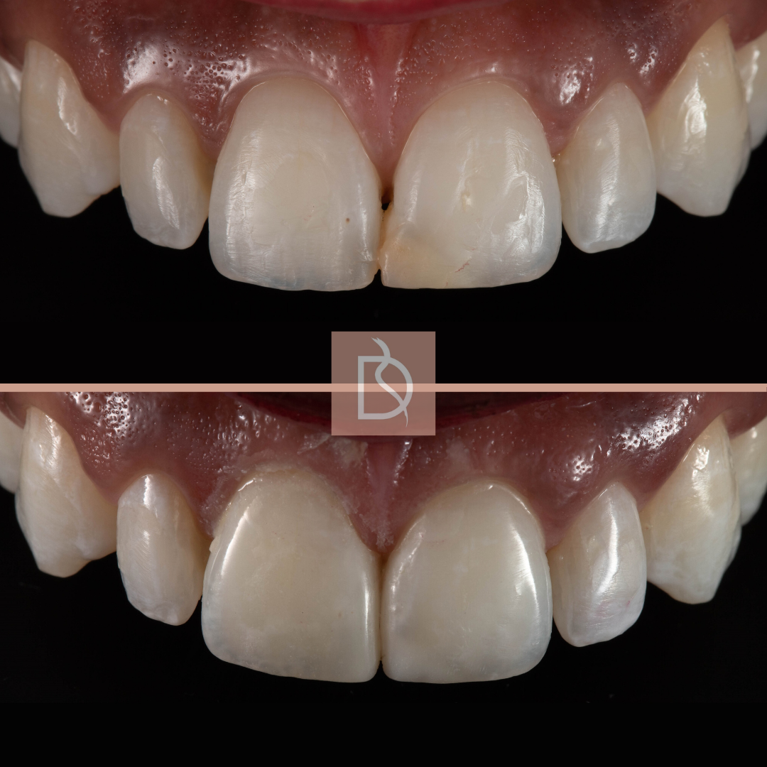 Types of Composite Bonding | Dental on the Banks