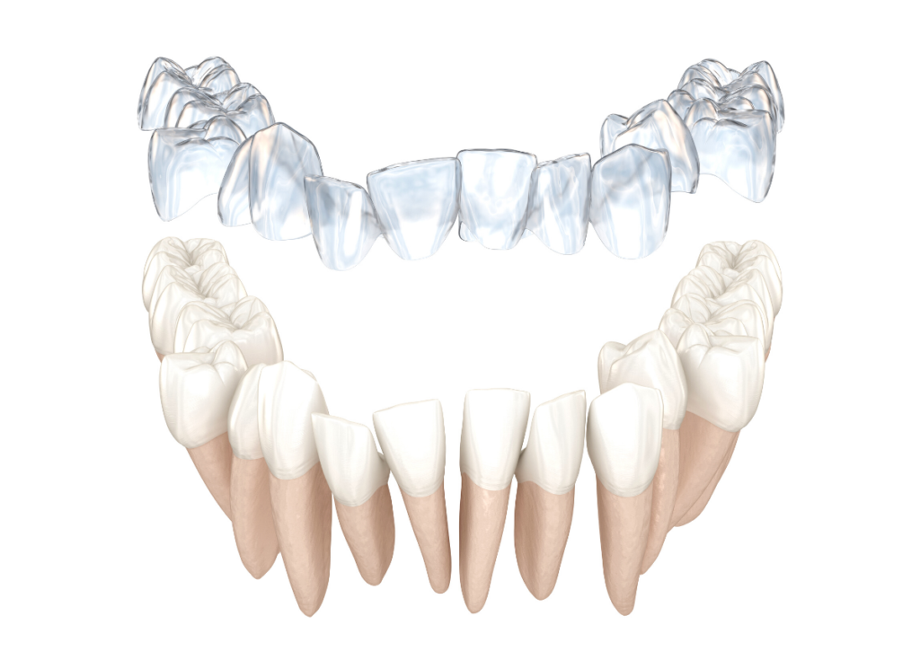 How Does Invisalign Work? | Dental on the Banks (Diamond II Provider)