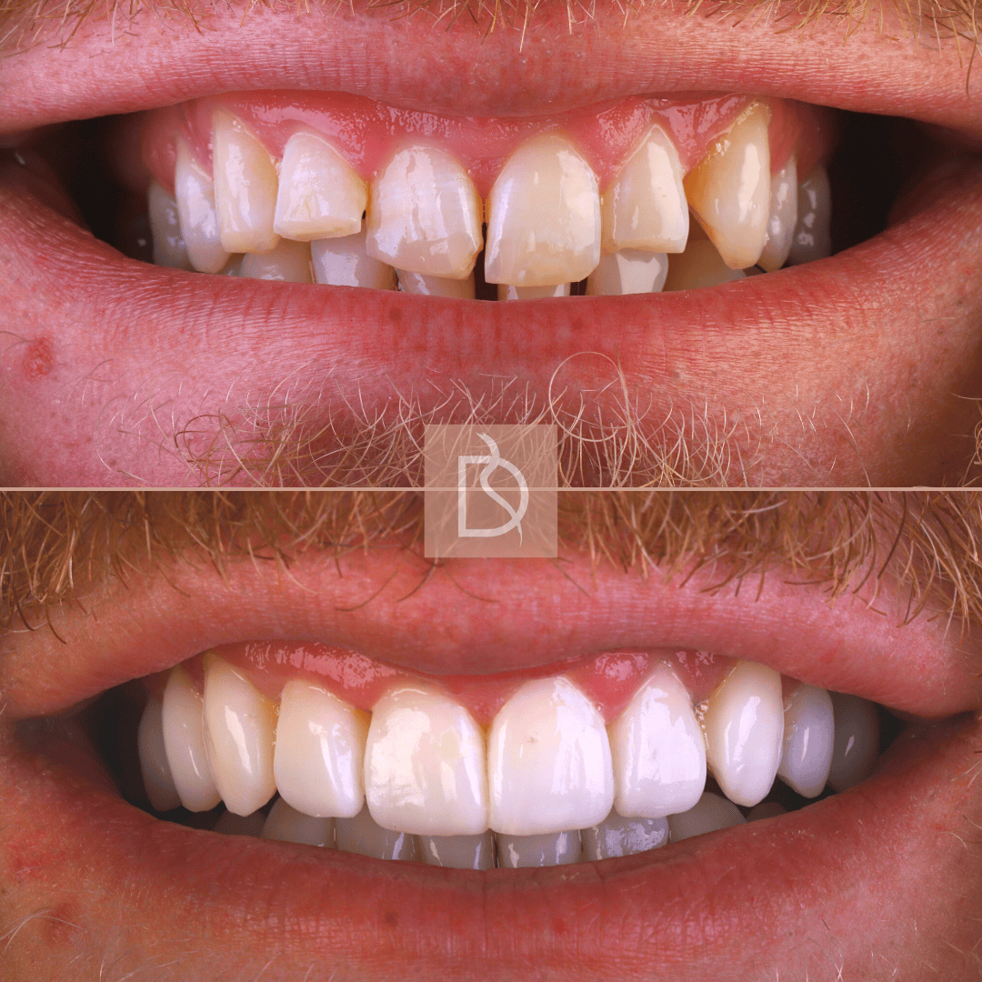 Composite Veneers in Poole | Dental on the Banks
